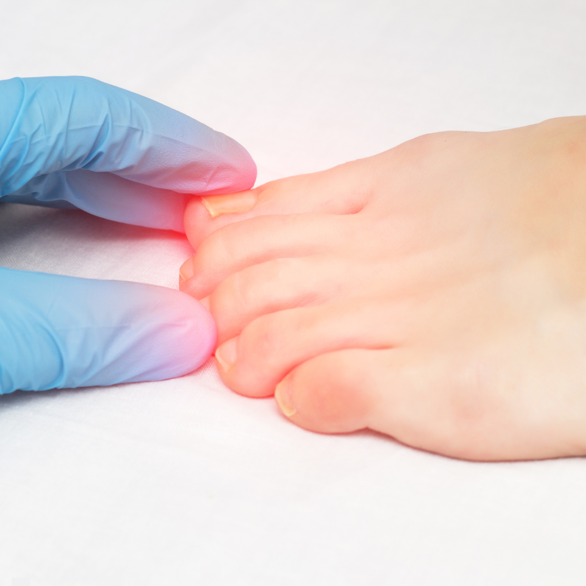 Ingrown Toe Nails – GMC Podiatry